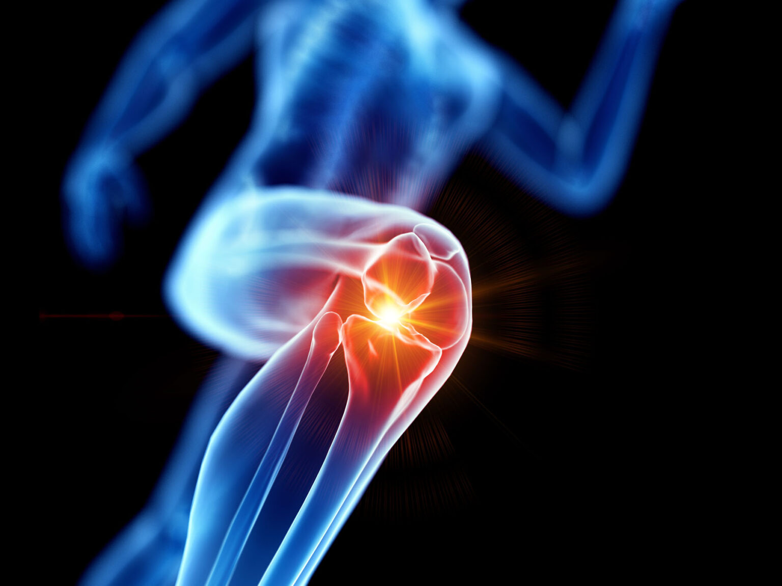 Genicular Nerve Blocks for Chronic Knee Pain