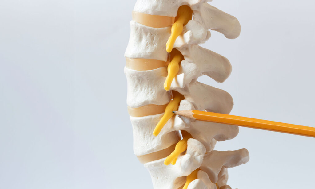 Dorsal Root Ganglion Neurotomy Melbourne